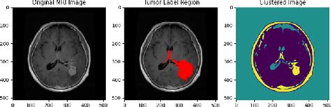 Integrating Preprocessing Methods And Convolutional Neural Networks For Effective Tumor