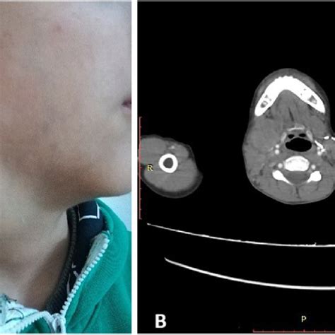 A Clinical View Of The Patient Showing Right Lateral Cervical Mass