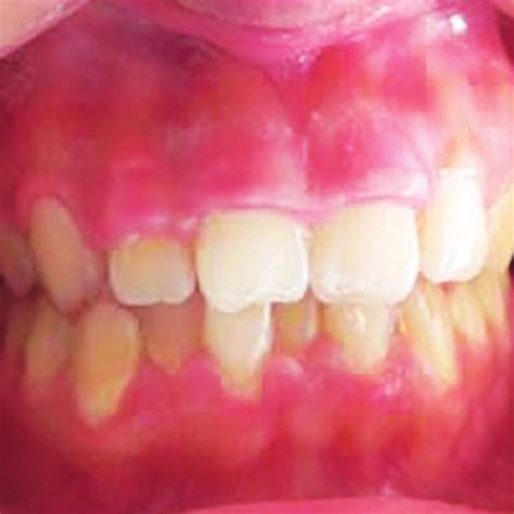 Pdf Esthetic Correction Of Gummy Smile By Gingivectomy Using Diode Laser