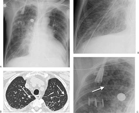 Ovid Chest Radiology The Essentials