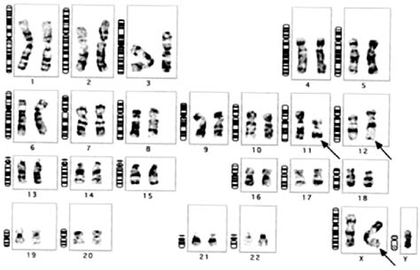 Conventional Cytogenetics Of Bone Marrow Cells Shows A 47xxy