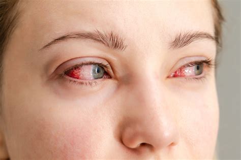 Bloodshot Eyes Causes And Treatments Valley Eyecare