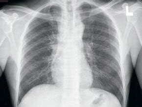 Chest X Rays Flashcards Quizlet