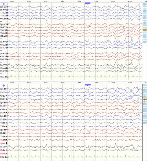 Awake Eeg Showing Normal Background Activity Bottom Longitudinal