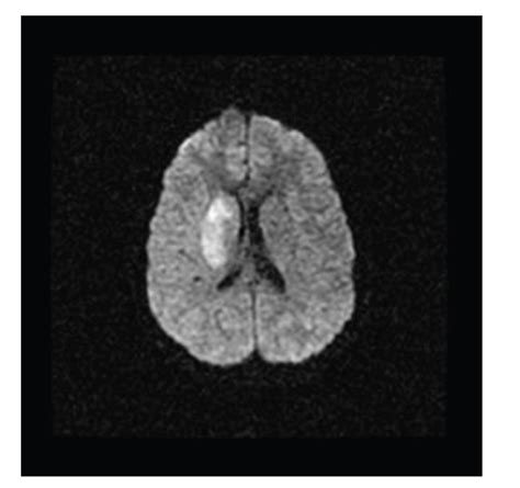 Diffusion Weighted Imaging Dwi Showing Area Of Restricted Diffusion Download Scientific Diagram
