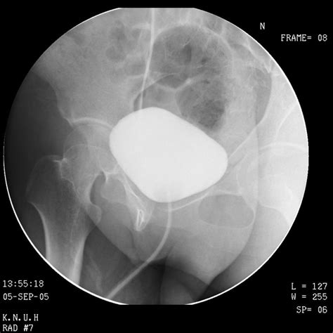 Post Operative Cycstography Showed No Visible Contrast Leakage And Any Download Scientific