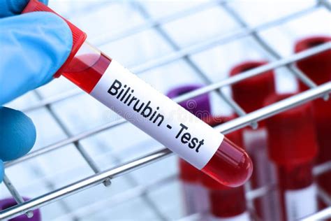 Bilirubin Test To Look For Abnormalities From Blood Stock Image Image Of Cell Experiment