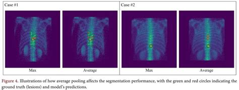 Scientific Research Publishing On Linkedin Bonemetastases Lesionsegmentation Dualpooling