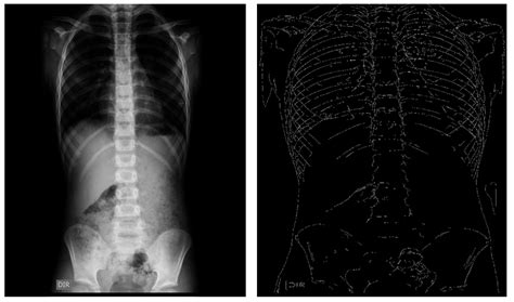 X Ray Vertebrae Detection Opencv Qanda Forum