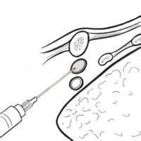 Supraclavicular Subclavian Vein Catheterization The Forgotten Central Line Critical Care