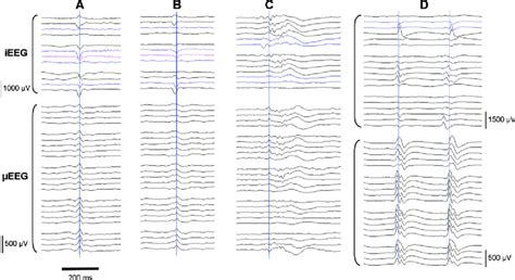 Macrodischarges And Their Ieeg Correlates Top Grouping Recordings Download Scientific Diagram