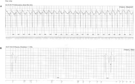 Vasovagal Ejaculation Syncope Heart