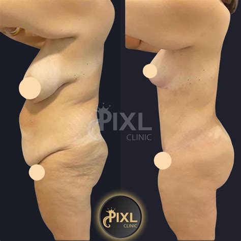 Tummy Tuck Before And After Pixl Clinic