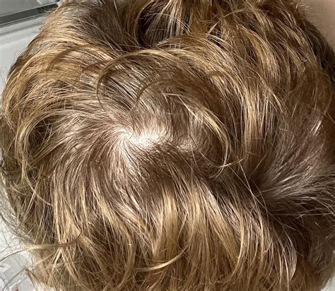 Is My Crown Balding Or Is This Normal For A Crown R Balding