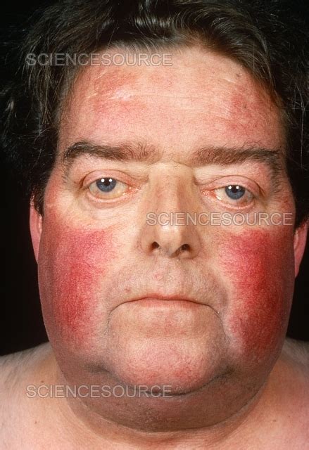 Cushings Disease Stock Image Science Source Images