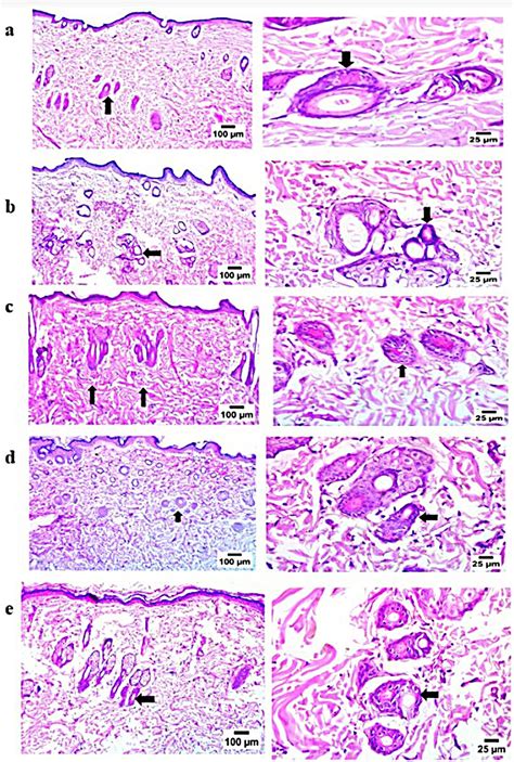 Alopecia Management Potential Of Rosemary Based Nanoemulgel Loaded Wit Ijn