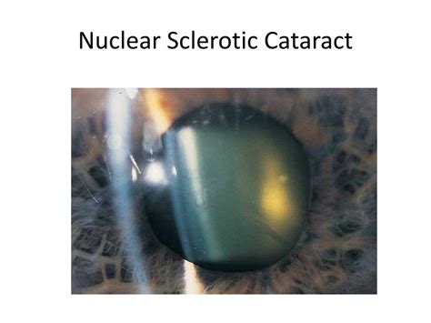 Ppt Ophthalmology For Finals Revision Lecture Powerpoint
