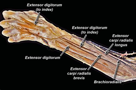 Extensor Indicis Cadaver