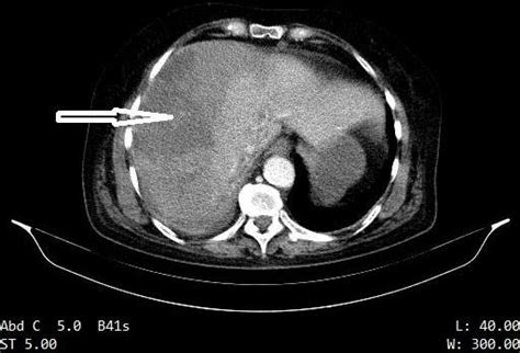 Right Lobe Liver Laceration In Segment 6 Download Scientific Diagram