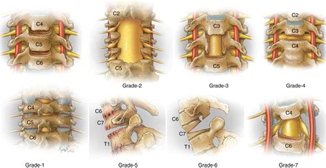 Cervical And Cervicothoracic Deformity Correction Posterior Based