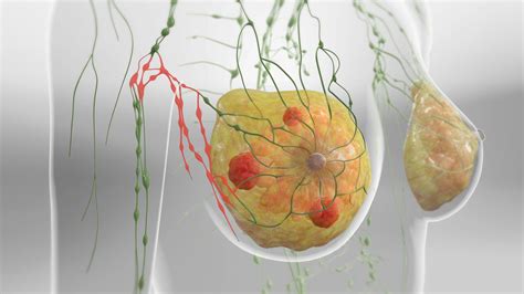 Difference Between Sentinel And Axillary Lymph Nodes 46 Off