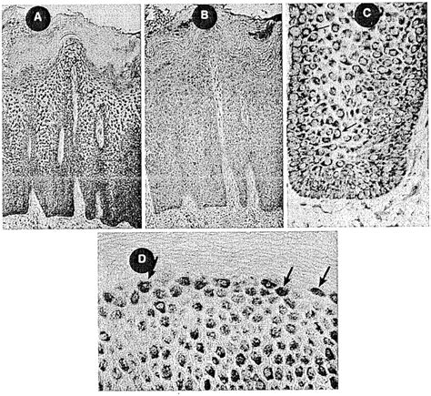 A D Iex 1 Immunostaining In Psoriatic Skin A Hyperplastic And