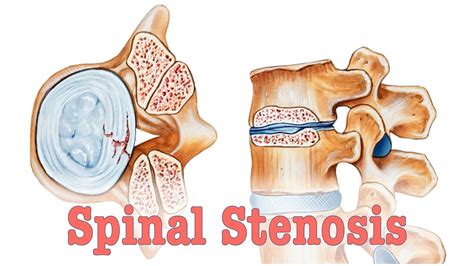 Spinal Stenosis Surgery Vs Chiropractic Care Youtube