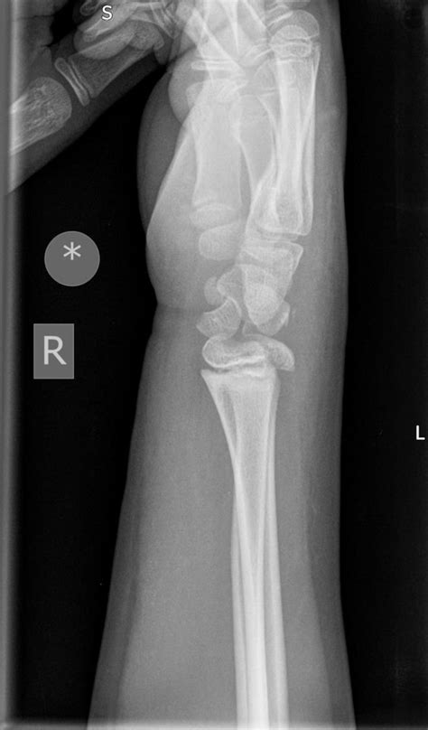 Lunate Dislocation