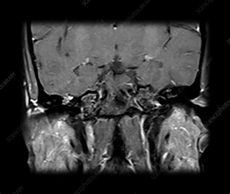 Facial Nerve Hemangioma Stock Image C0433188 Science Photo Library