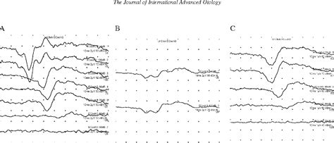 Figure 2 From Intraoperative Electrocochleography For Monitoring During