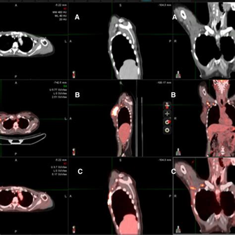 Representative Images After Deformable Image Registration A