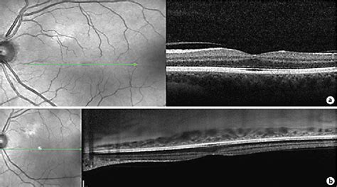 Figure 2 From Flat Choroidal Nevus Inaccessible To Ultrasound Sonography Evaluated By Enhanced