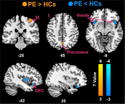 Voxel Wise Comparison Of Dc Value Between Lifelong Pe Patients And Hcs