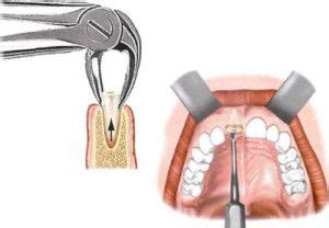 Extracciones Dentales Indicaciones Y Contraindicaciones