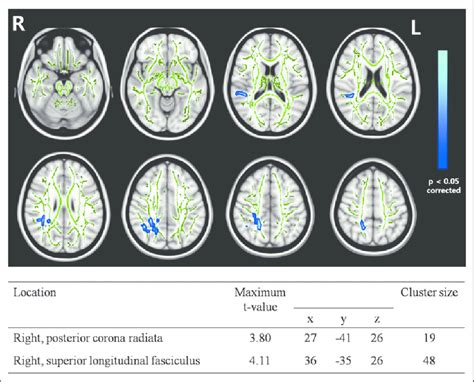 Tract Based Spatial Statistics Results Of Mean Diffusivity Showing