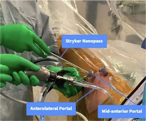 Intraoperative Image Of A Left Acetabular Labral Repair Displaying The Download Scientific
