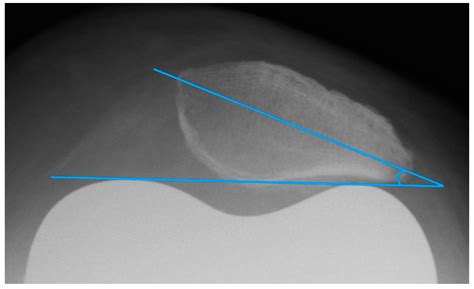 Diagnostics Free Full Text Patellar Tracking In Total Knee