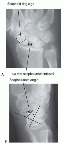Reduction And Association Of The Scaphoid And The Lunate For Scapholunate Instability