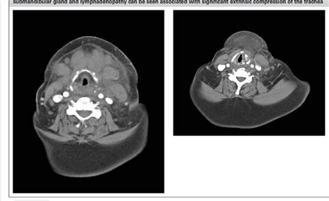 Figure 1 From Lumps Bumps And Vasculitis Semantic Scholar