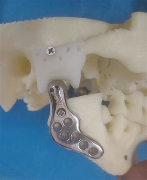 Mandible Component With Fossa On A 3d Model Download Scientific Diagram