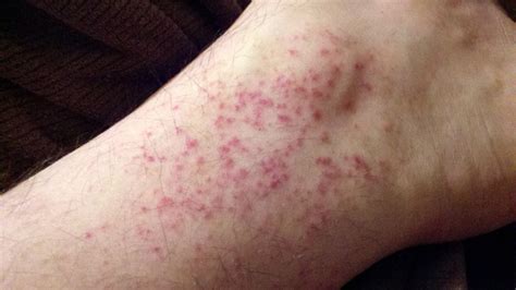 Heat Rash Prickly Heat Miliaria Rubra Healthtian