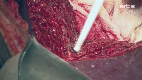 Living Donor Right Hepatectomy With Erbejet® 2 Medical Videos