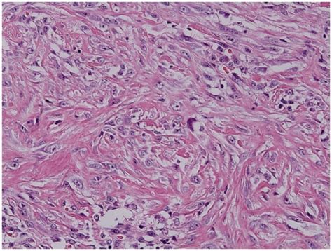 What Is Nodular Fasciitis Pathosomes