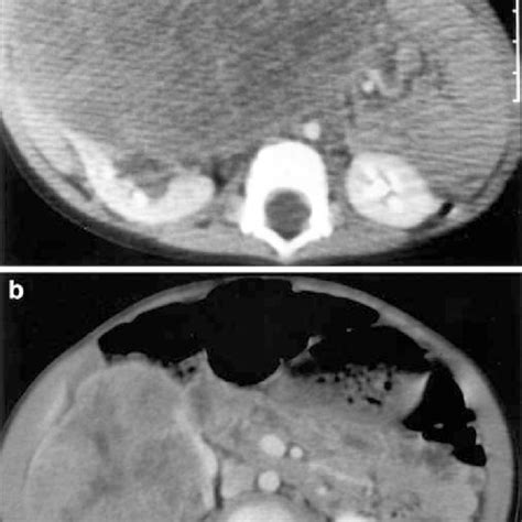 A Patient No 2 Initial Tumor Volume 1346 Ml B Patient No 2