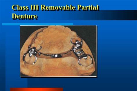 Ppt Principles Of Rpd Design Powerpoint Presentation Id 2029079