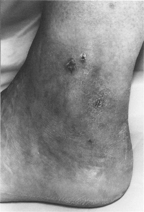 Complete Healing Of The Pyoderma Gangrenosum Eight Weeks After The