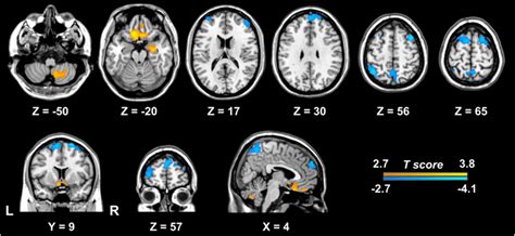 Brain Regions With Local Fcd Alterations In Chronic Migraine Compared Download Scientific
