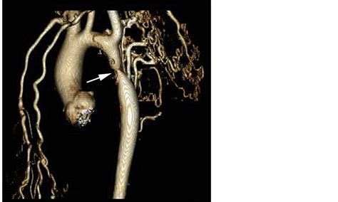 Computational Fluid Dynamics Analysis Of The Aortic Coarctation