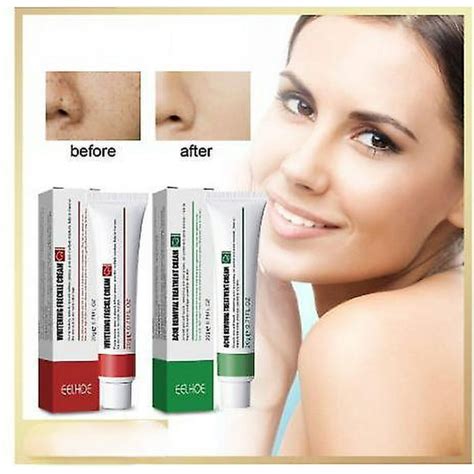 Crema Para Eliminar Acné Y Manchas Manchas Aclaradoras Y Piel Brillante