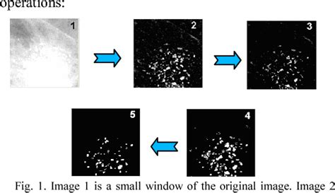 Figure 1 From Detection And Classification Of Microcalcifications